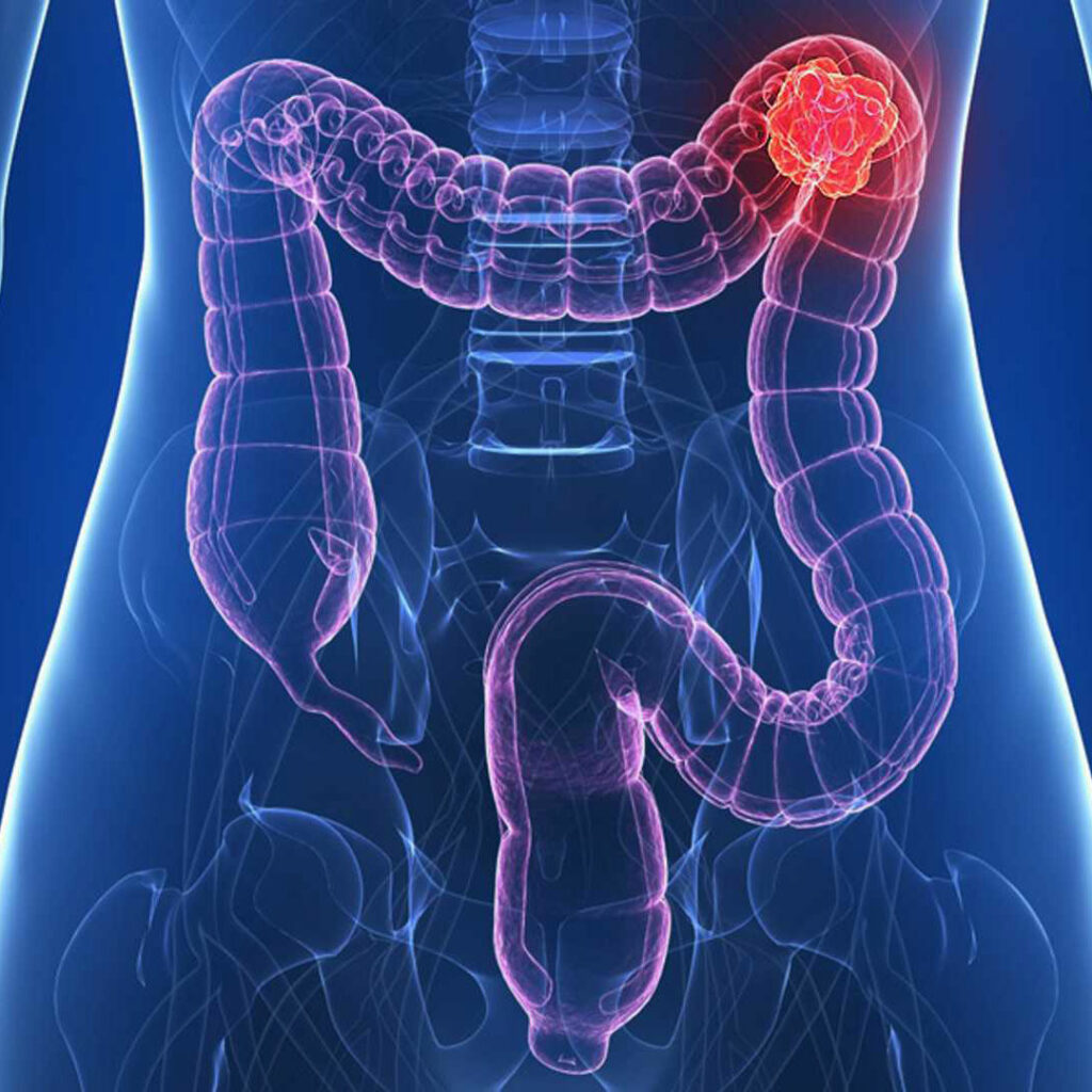 Colon (Large Intestine) Cancer Awareness Month - Elite Hospital