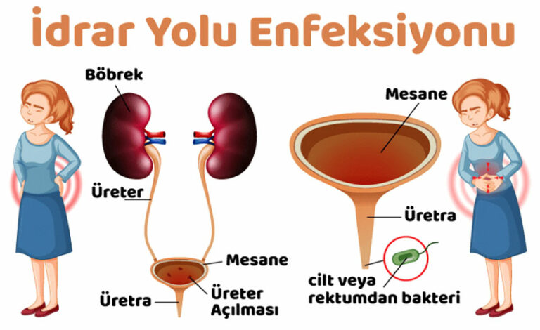 İdrar Yolu Enfeksiyonu Nasıl Tedavi Edilir? - Elite Hospital
